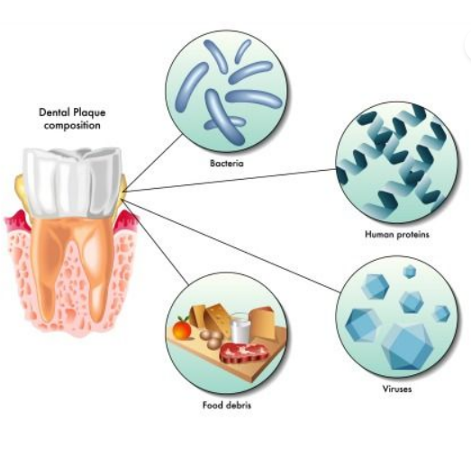 Tartar - An Unwanted Companion Slowly Destroying Your Teeth